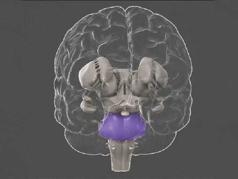 Medical Case Report: Hyperbaric Oxygen Therapy in Central Pontine ...