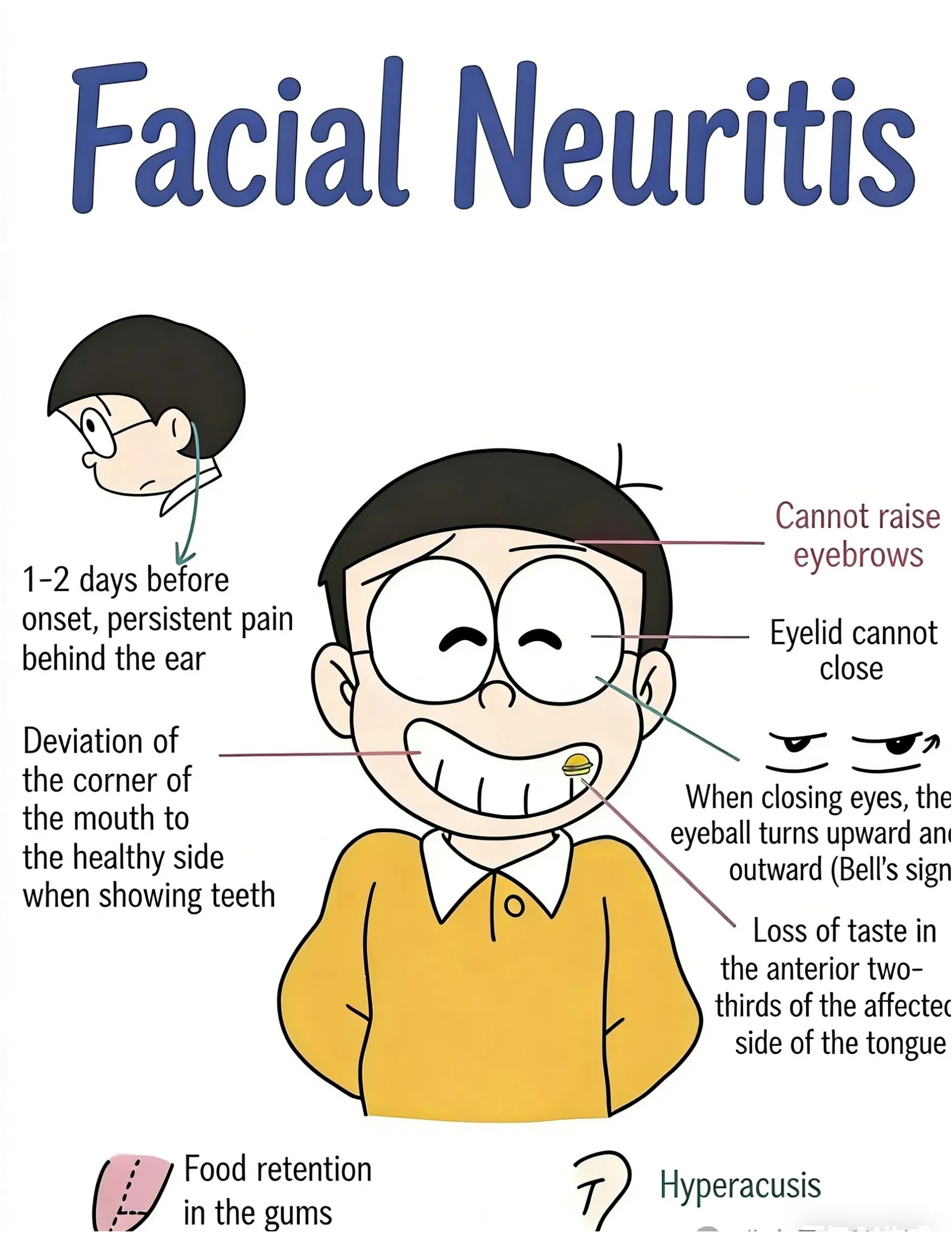 HBOT for Bell's Palsy - BaoBang